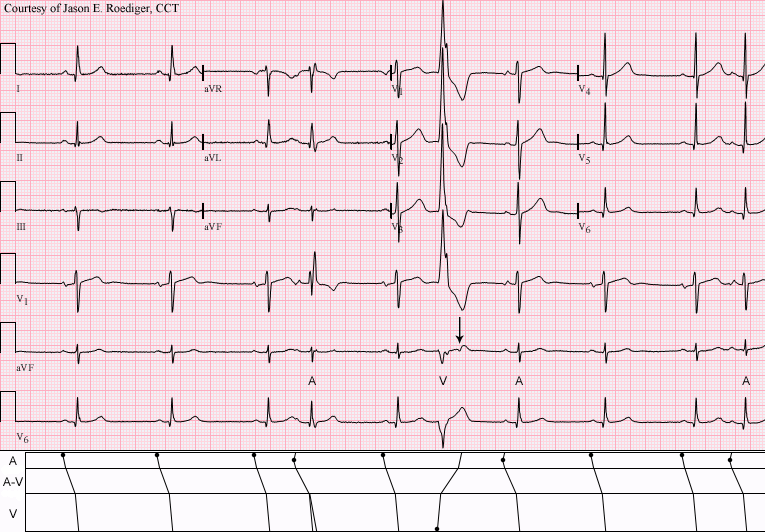 Bunny Ears Ecg Meaning